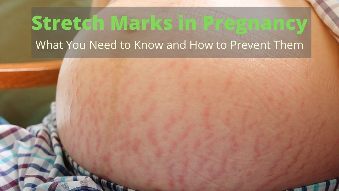 Stretch Marks in Pregnancy – SpeciallyMe®